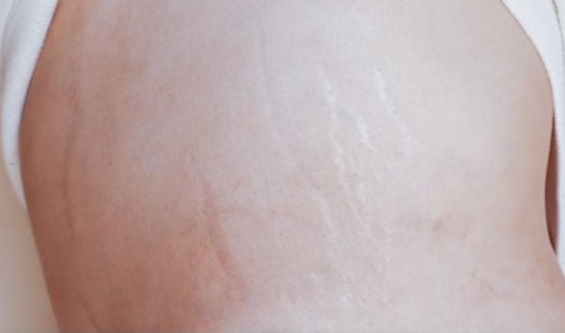 Cara Mengenali Penyebab dan Penanganan Stretch Mark - kabarpangandaran.com